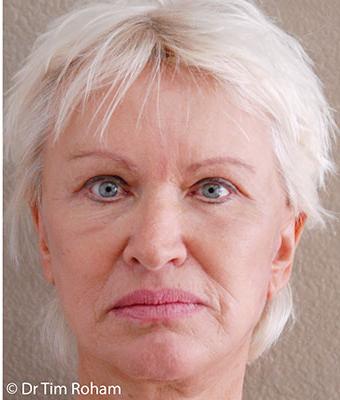 Patient #1246 Face Lift Before and After Photos Santa Ana - Plastic ...