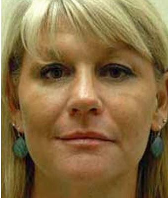 Patient #1391 Fat Transfer Face Before and After Photos Santa Ana ...