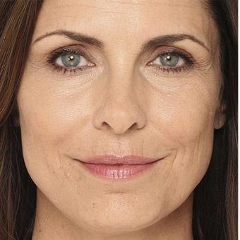 Patient #1488 Radiesse Before and After Photos Santa Ana - Plastic ...