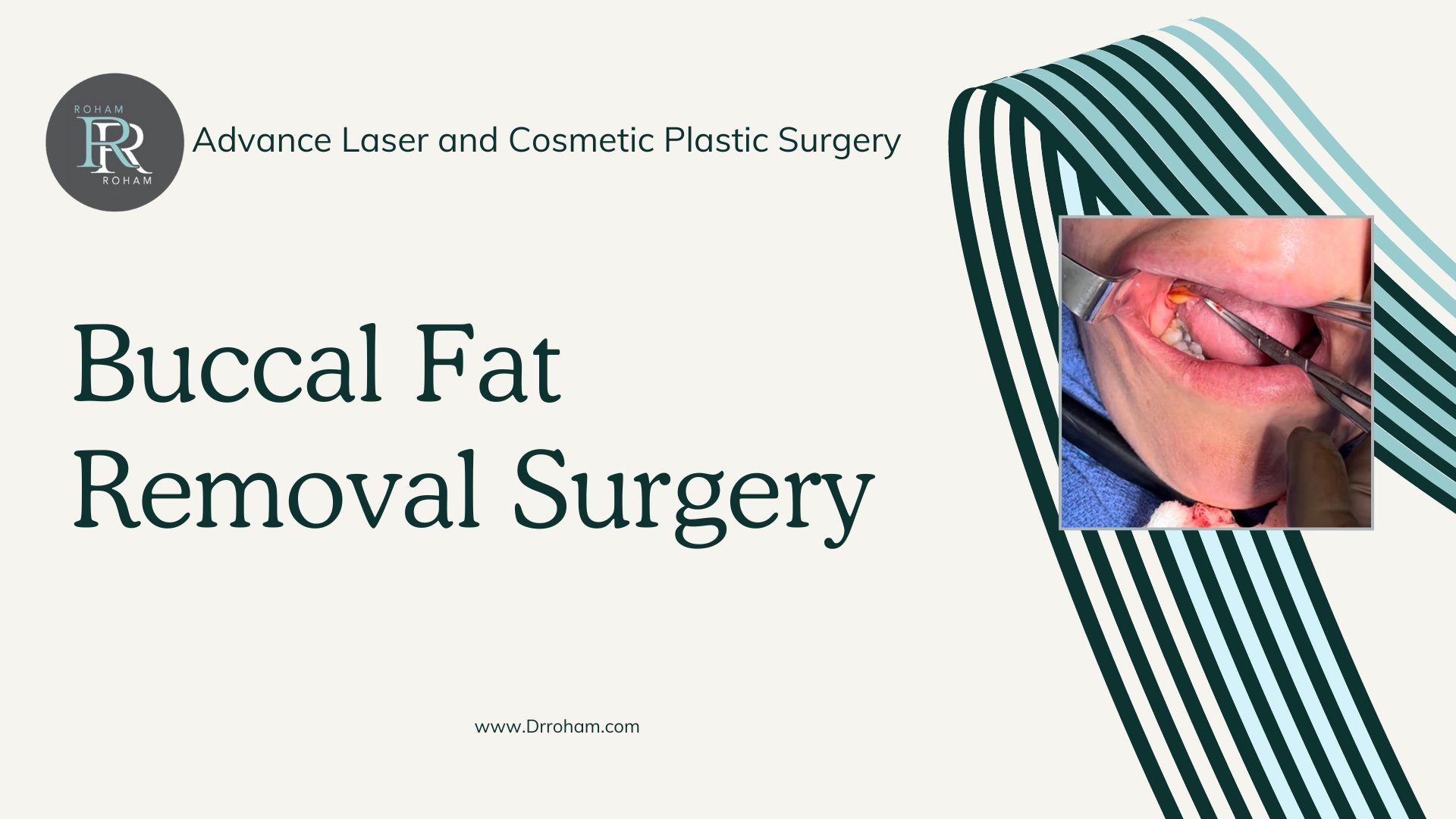 Best Buccal Fat Removal Orange County, CA | Roham Advance